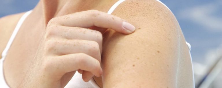 Self Examination for Skin Cancers - Lifestyle Skin Health Clinic